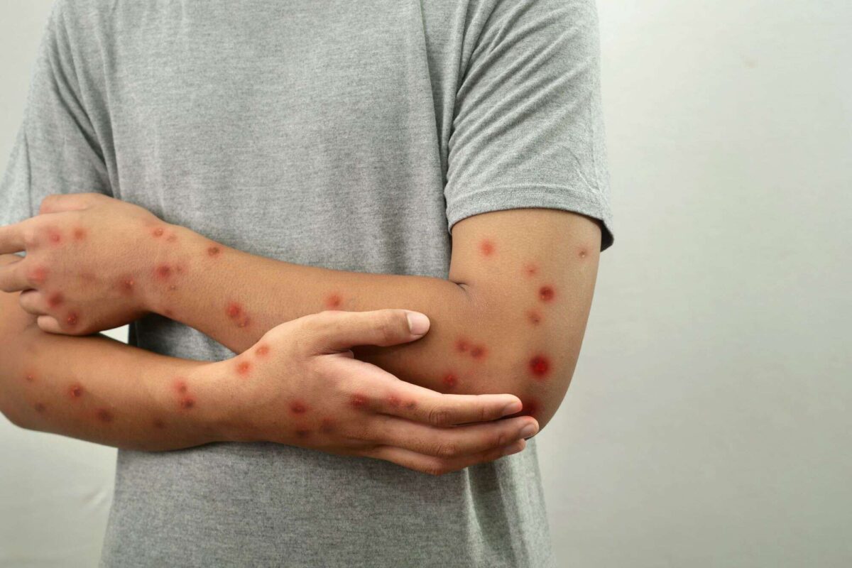 MPOX: estes sintomas iniciais estão fazendo brasileiros procurarem ...